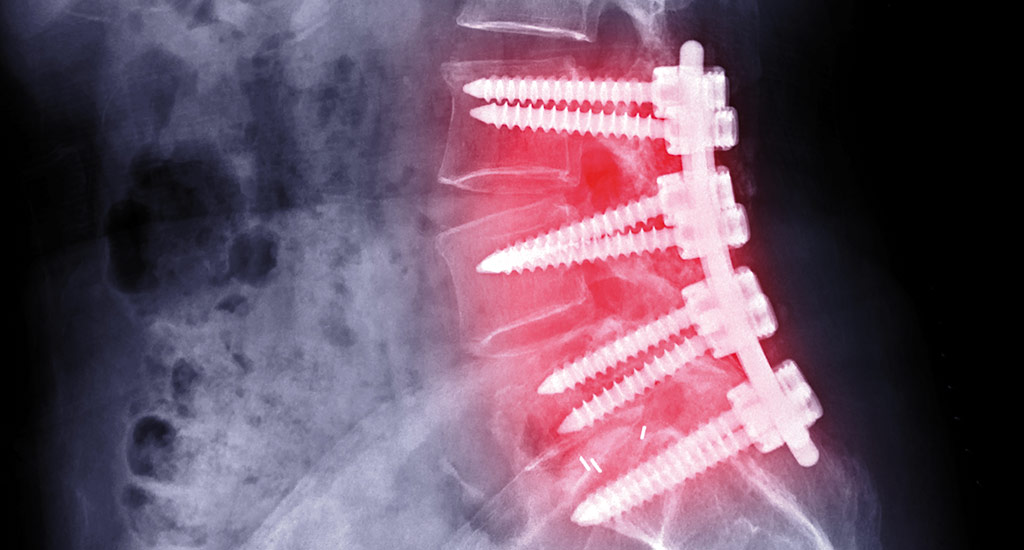 Implant-Grade Tubes for Medical Devices | Stainless Steel, Titanium ...